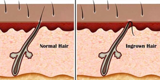 Ingrown Hair on Head/Scalp Causes, Symptoms, Treatment Ingrown Hair on Head/Scalp Causes, Symptoms, Treatment