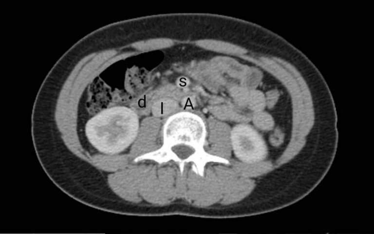 Wilkie s Syndrome Symptoms Causes Surgery Life Expectancy wilkie-s-syndrome-symptoms-causes-surgery-life-expectancy