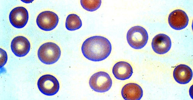 Anisocytosis Causes, Symptoms, Diagnosis,Treatment