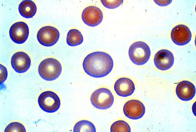 Anisocytosis Causes, Symptoms, Diagnosis,Treatment