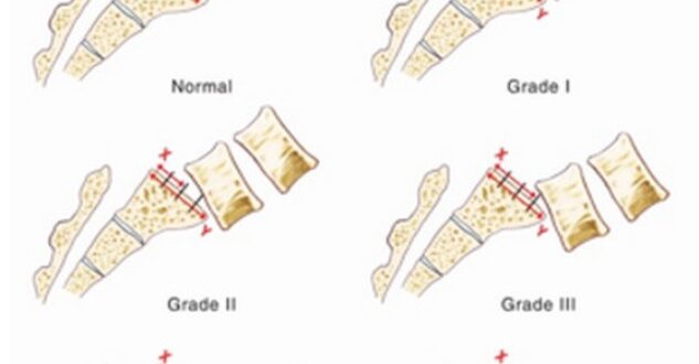 Anterolisthesis Grade 1-2, Treatment, Symptoms, Causes