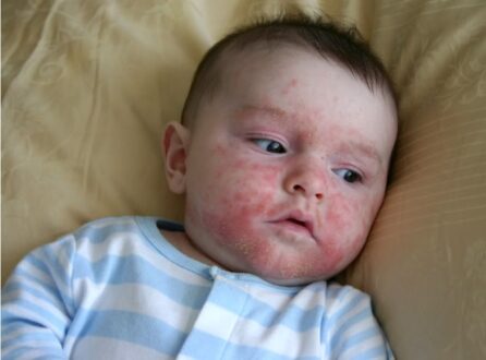 What is Infantigo (Impetigo) - Images, Treatment, Causes, Symptoms