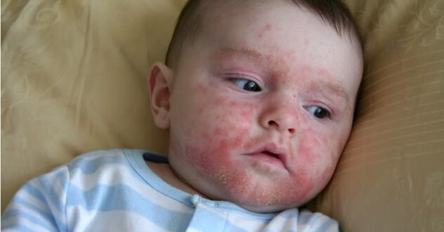 What is Infantigo (Impetigo) - Images, Treatment, Causes, Symptoms