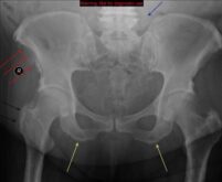 Ischial Tuberosity Syndrome Pain, Pictures, Treatment