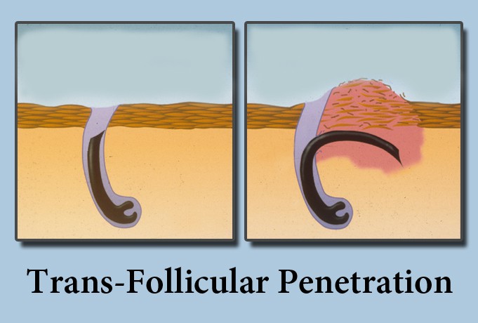 Ingrown Hair on Head/Scalp Causes, Symptoms, Treatment