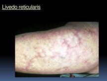 Livedo Reticularis (Mottling Skin) Causes, Pictures, Treatment