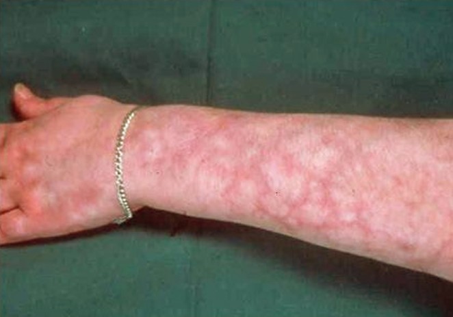 Livedo Reticularis (Mottling Skin) Causes, Pictures, Treatment