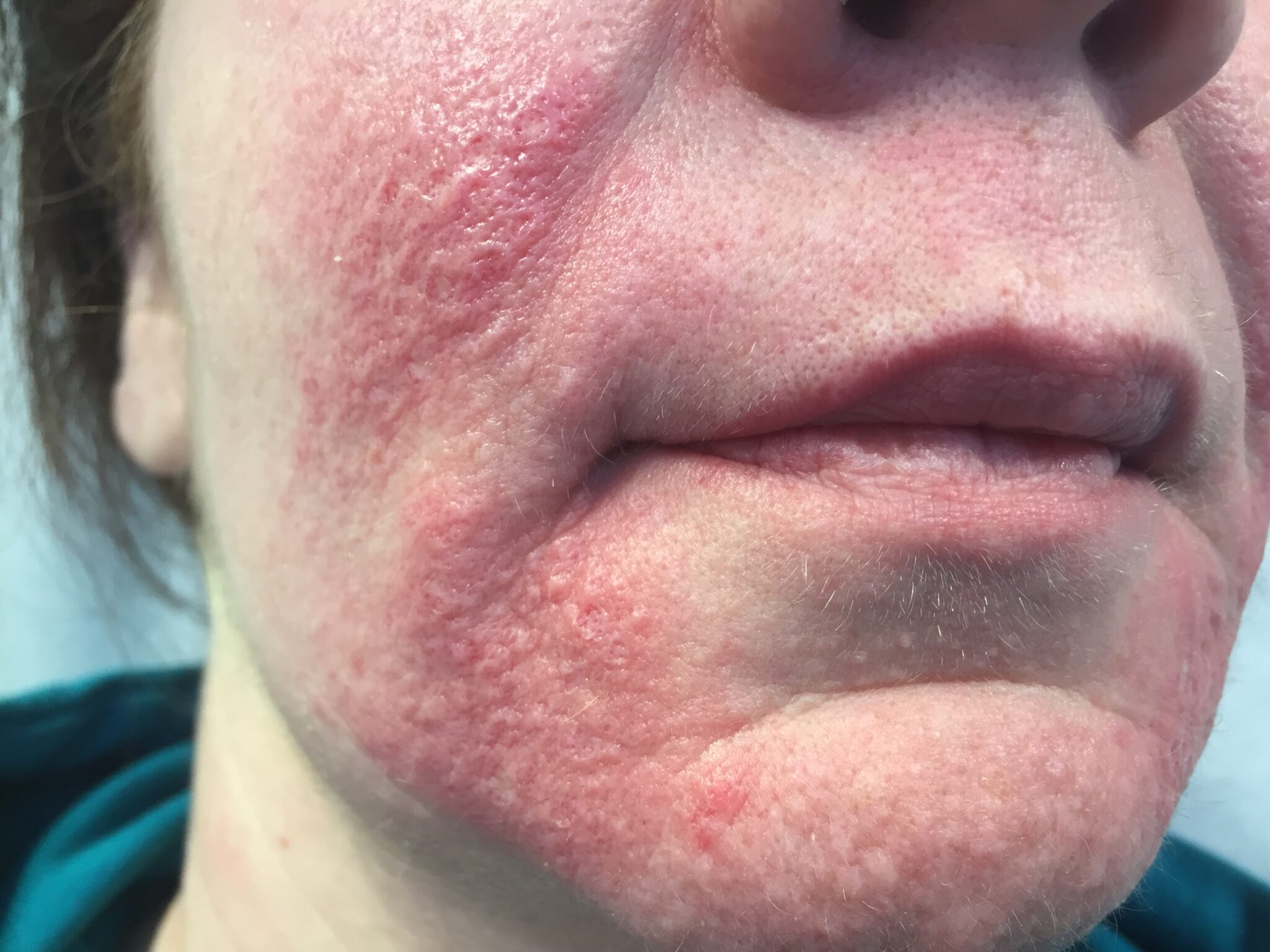 Sebaceous Glands Hyperplasia Photos and Treatment