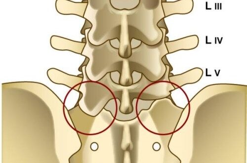 Sacralization of L5 - Definition, Symptoms, Treatment