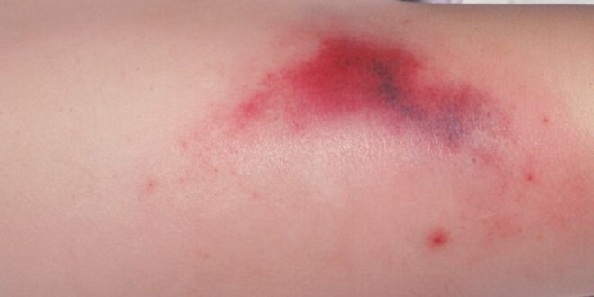 Ecchymosis definition, bruising Pictures, Causes, Treatment