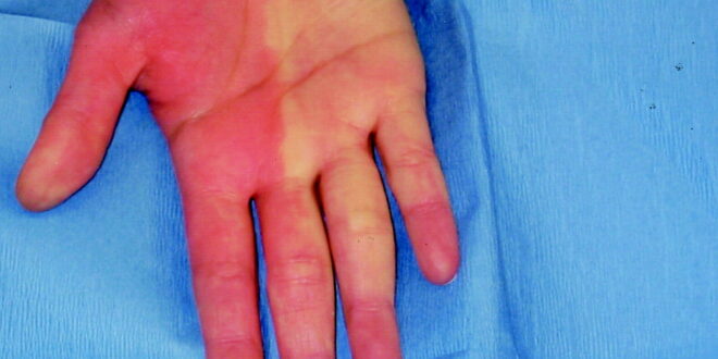 Allen test Procedure, Results, Types, Positive Allen test