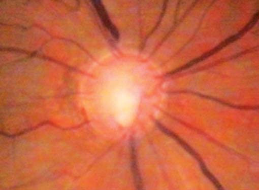 Morning Glory Syndrome Definition, Symptoms, Causes, Treatment