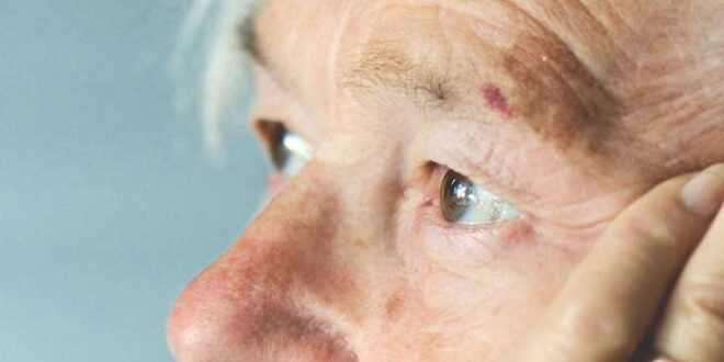 Parinaud Syndrome Definition, Symptoms, Causes, Treatment