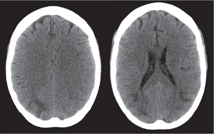 Superficial Siderosis Progression, Life Expectancy, Causes, Treatment