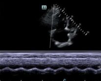 Tapse Echocardiography Normal & Abnormal Value, Measurement