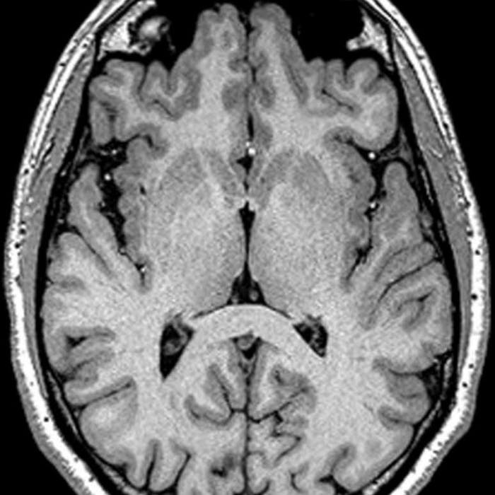 Heschl's Gyrus Location, Function, Damage, Lesion