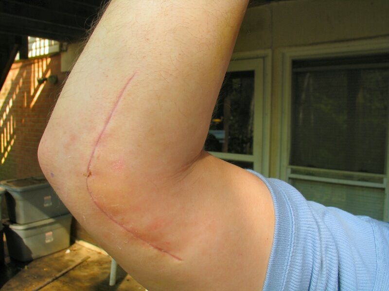 Submuscular Ulnar nerve transposition Rehab protocol, recovery time ...