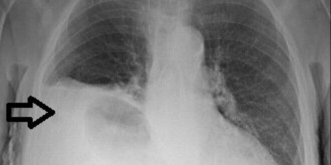 Morgagni Hernia Symptoms, Causes, Surgery