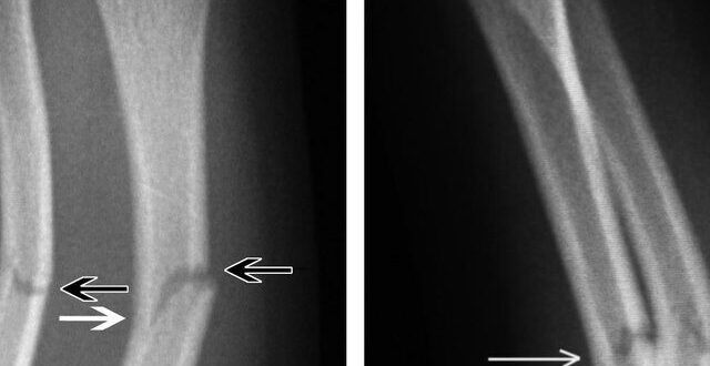 Greenstick vs Nightstick Fracture Difference, Symptoms, Causes, Treatment
