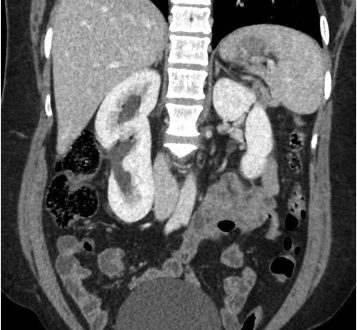 Supernumerary kidney Symptoms, Causes, Complications, Treatment
