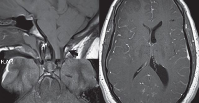 Uncal Herniation Symptoms, Causes, Types, Treatment