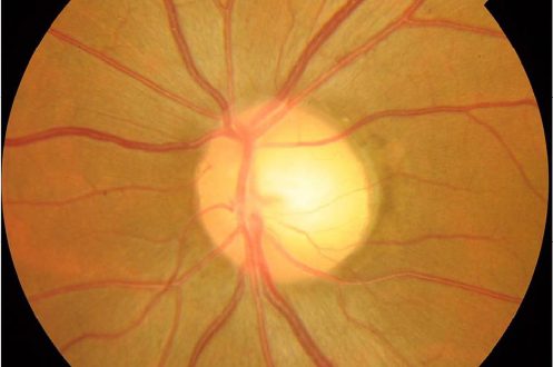 Centrocecal Scotoma Symptoms, Causes, Treatment