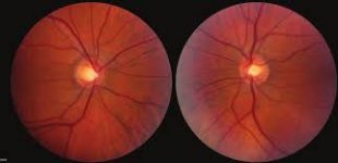 Centrocecal Scotoma Symptoms, Causes, Treatment