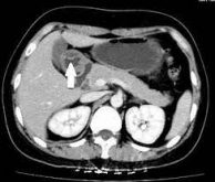 Foregut Duplication Cyst Location, Symptoms, Causes, Treatment