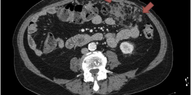 Omental Caking Symptoms, Causes, Radiology, Prognosis, Treatment