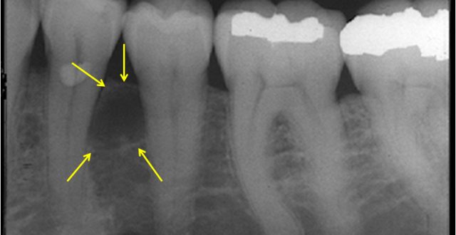 Radicular Cyst Symptoms, Causes, Radiology, Treatment