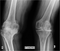 Windswept Deformity Location, Symptoms, Causes, Diagnosis, Treatment