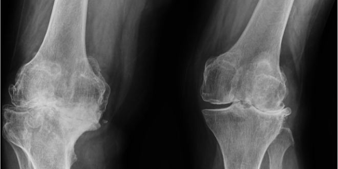 Windswept Deformity Location, Symptoms, Causes, Diagnosis, Treatment