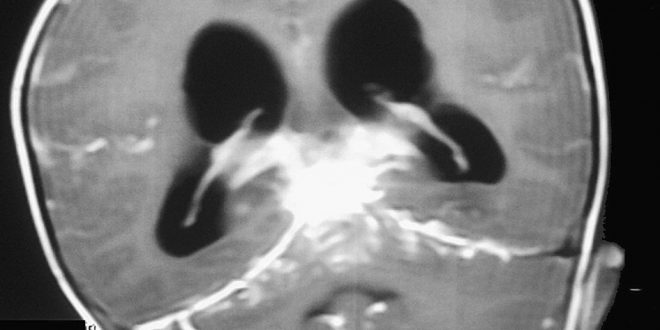 Pachymeningitis Symptoms, Causes, Treatment