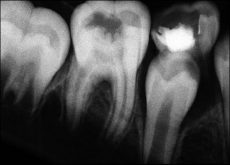 Apexogenesis Procedure, Indications, Steps | Apexogenesis vs Apexification