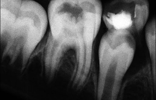 Apexogenesis Procedure, Indications, Steps | Apexogenesis vs Apexification