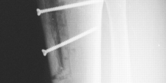 Fulkerson Osteotomy Success Rate, Recovery Time, Complications, Cost