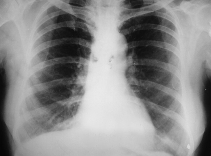 Hamman-rich Syndrome Symptoms, Causes, Diagnosis, Treatment