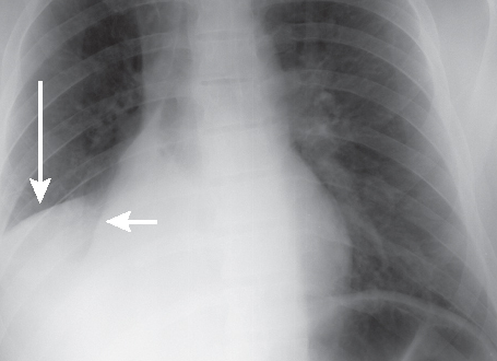 Middle Lobe Syndrome Symptoms, Causes, Diagnosis, Treatment