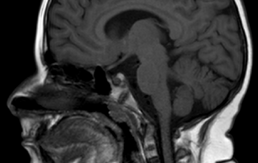 Tornwaldt Cyst Symptoms, Causes, Diagnosis, Treatment