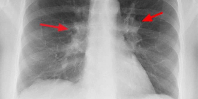 Right Hilar Lymph Node Enlargement, Location, Metastasis, Calcification