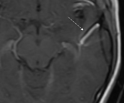 Venous Angioma Symptoms, Causes, Diagnosis, Treatment