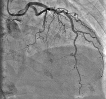Kounis Syndrome Symptoms, ECG, Diagnosis, Causes, Treatment