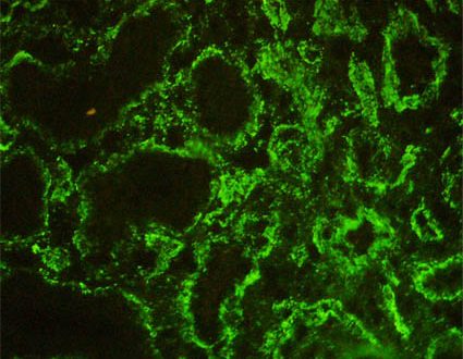 Pauci Immune Glomerular Nephritis Symptoms, Causes, Treatment