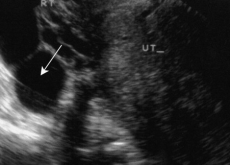 Pyosalpinx Symptoms, Causes, Treatment | Pyosalpinx vs Hydrosalpinx