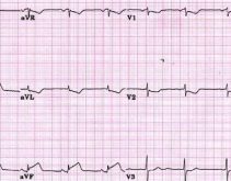 Anteroseptal infarct Symptoms, Cause, ECG/EKG, Treatment