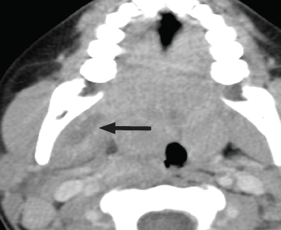 Masticator Space Definition, Abscess, Mass, Infection, Boundaries