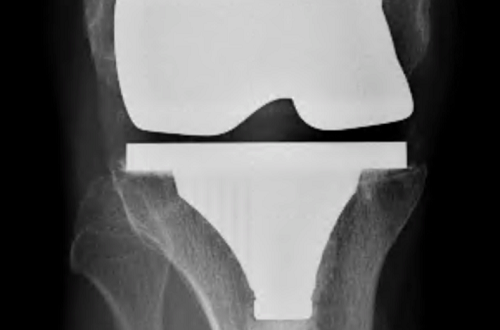 Patellar Resurfacing Surgery, Procedure, Technique, Recovery Time