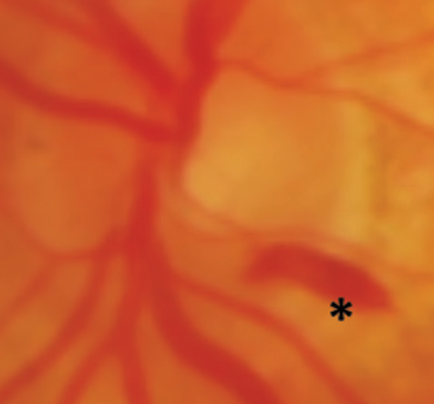 Subhyloid Hemorrhage Meaning, Symptoms, Causes, Treatment | Preretinal ...