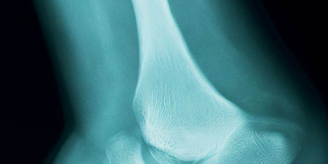 Mueller Weiss Syndrome Symptoms, Causes, Treatment