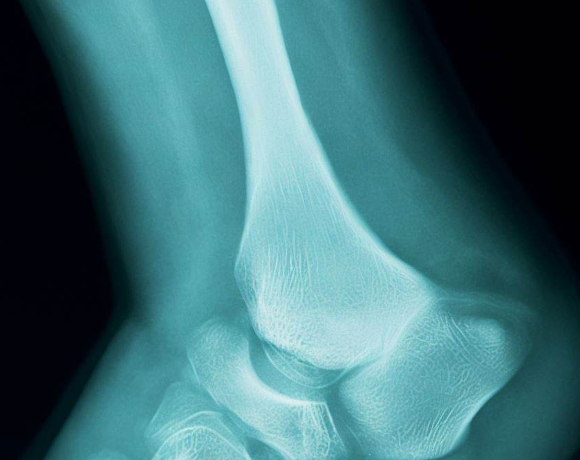 Mueller Weiss Syndrome Symptoms, Causes, Treatment